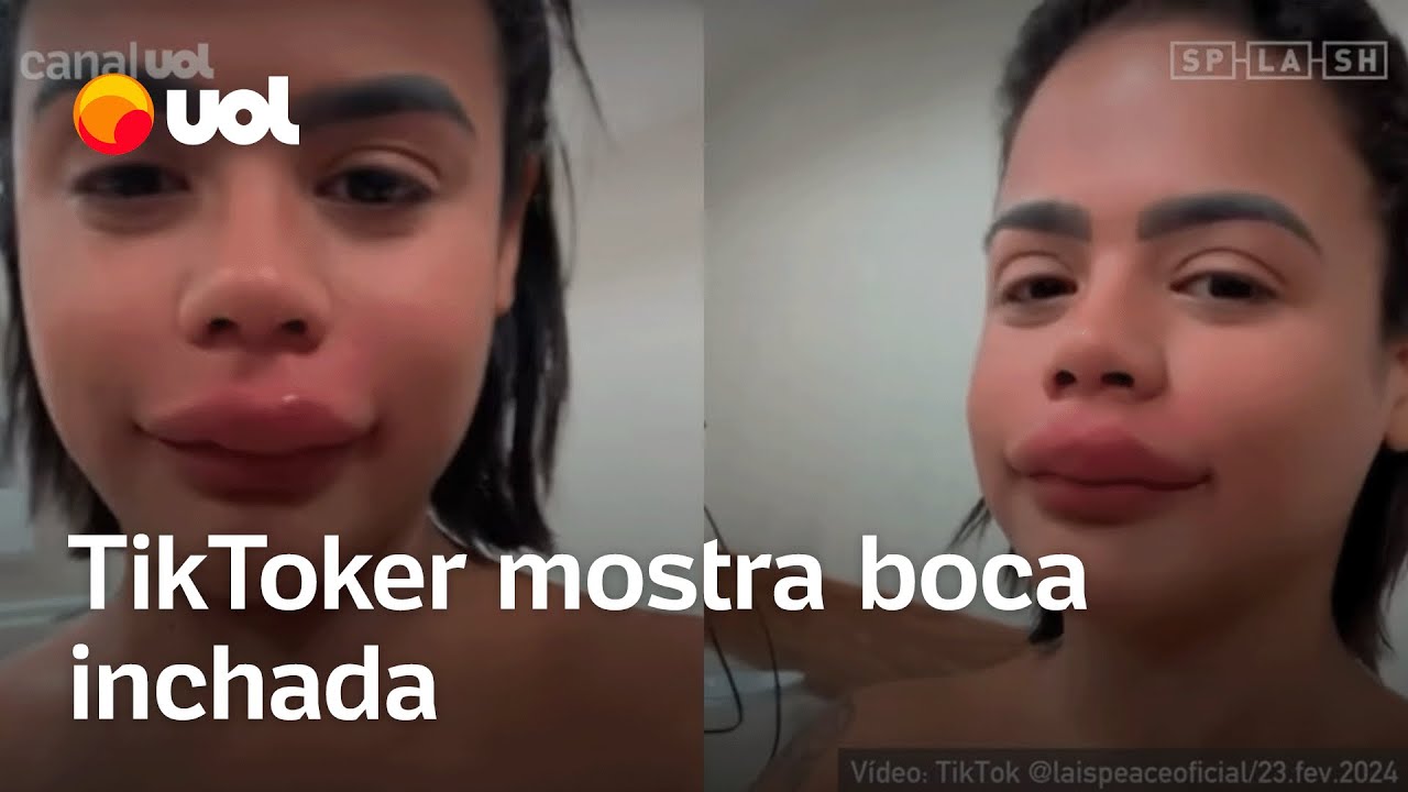 Influencer impressiona ao mostrar boca inchada e chora com ...