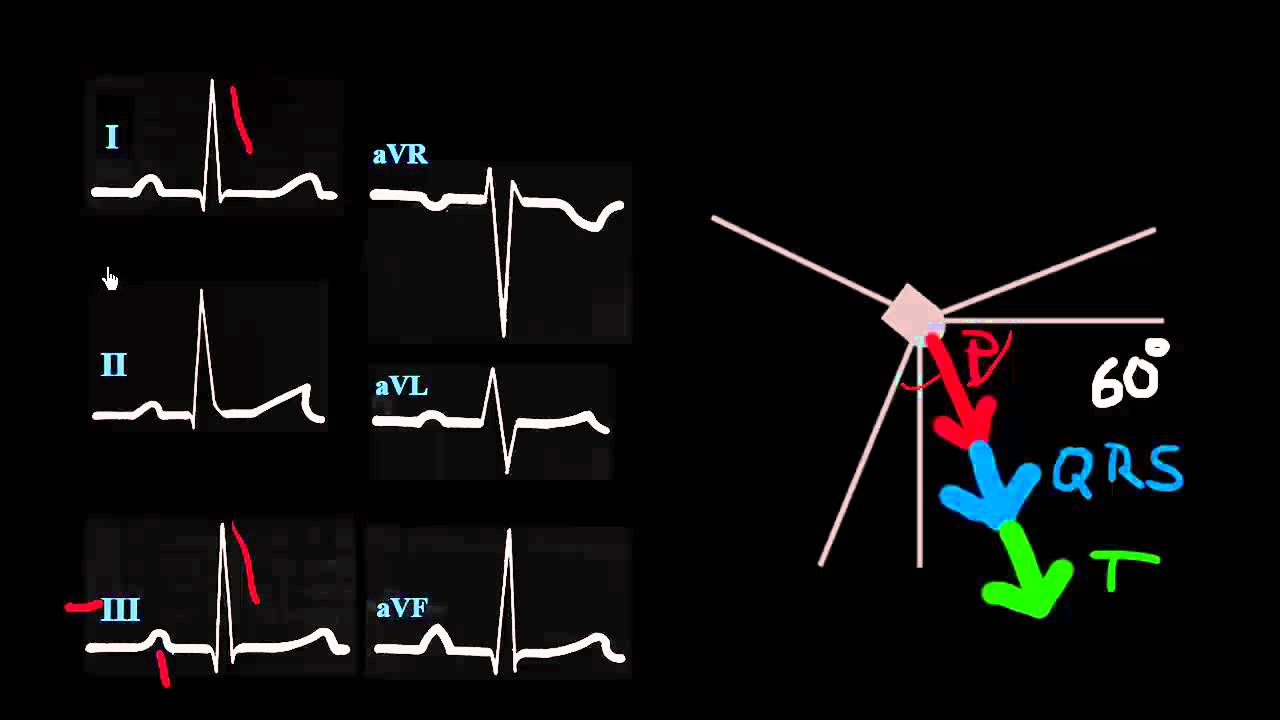 CURSO DE ELECTROCARDIOGRAFIA 20 - RESUMEN DE LA MORFOLOGÍA NORMAL DEL ...