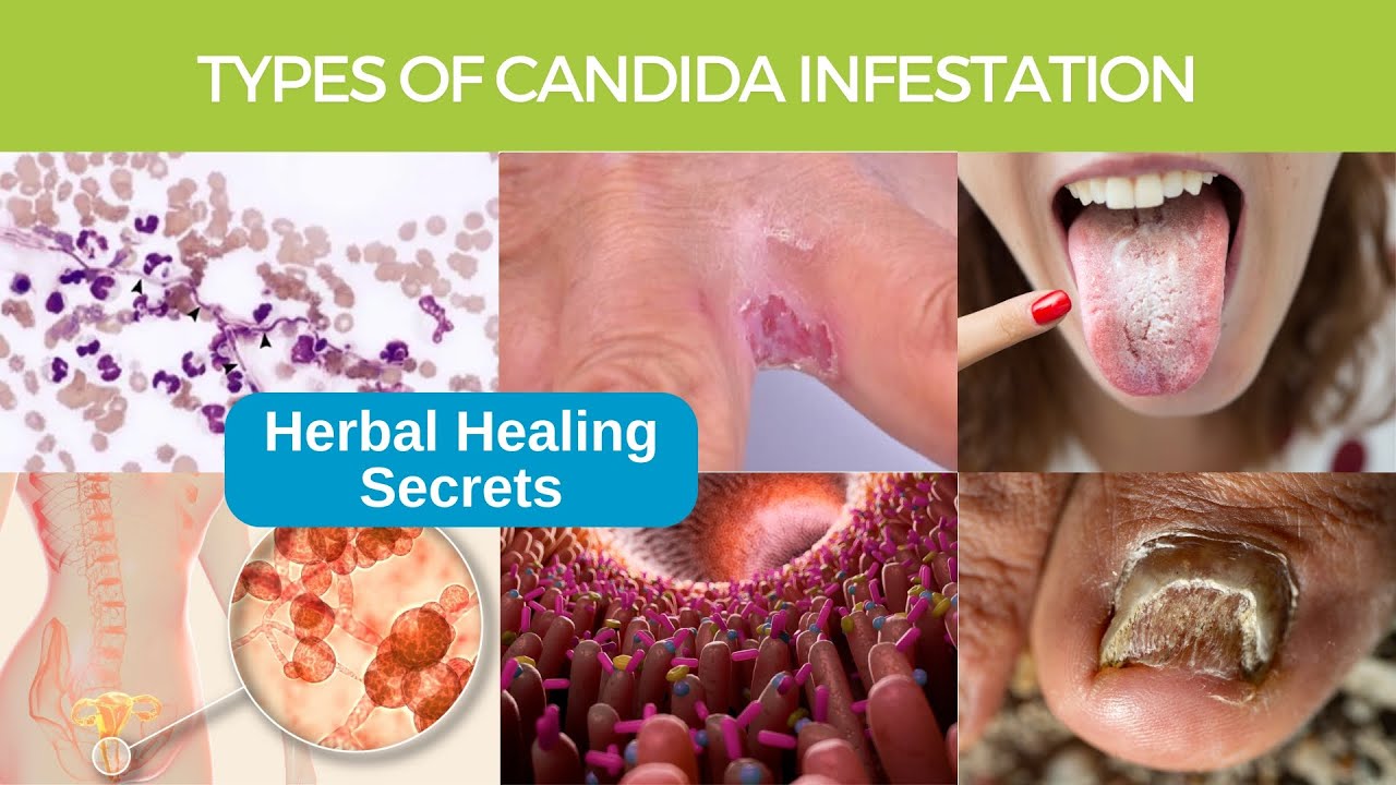 Types Of Candida And Thrush Infestation - Secrets Of Herbal Healing ...