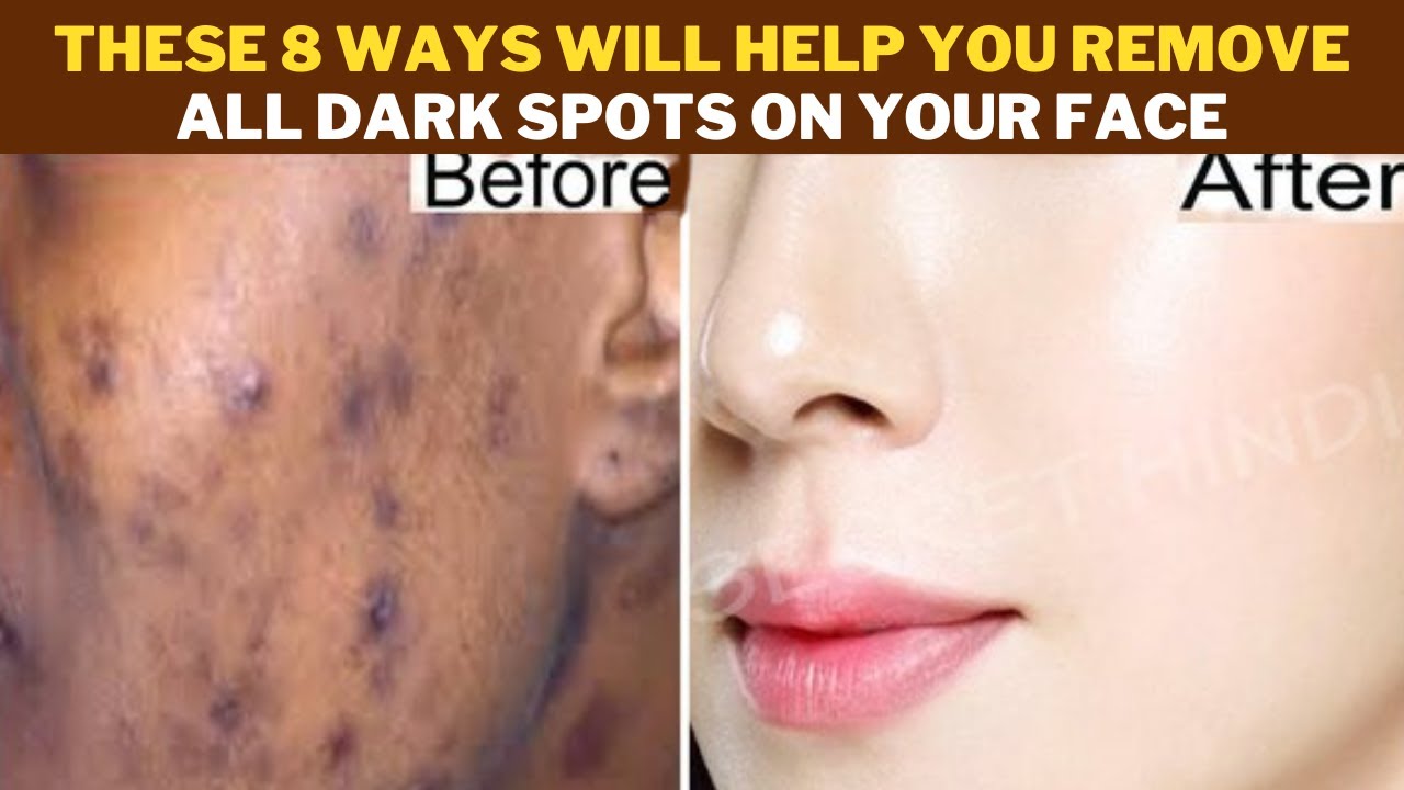 Best Ways to Reduce Dark Spots On The Face | Get Rid Of Dark Spots ...