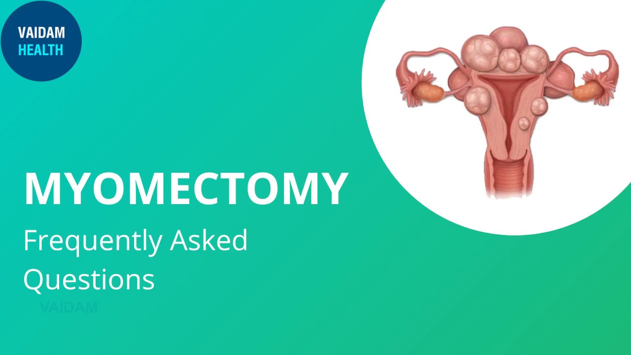 Myomectomy- Frequently Asked Questions - YouTube