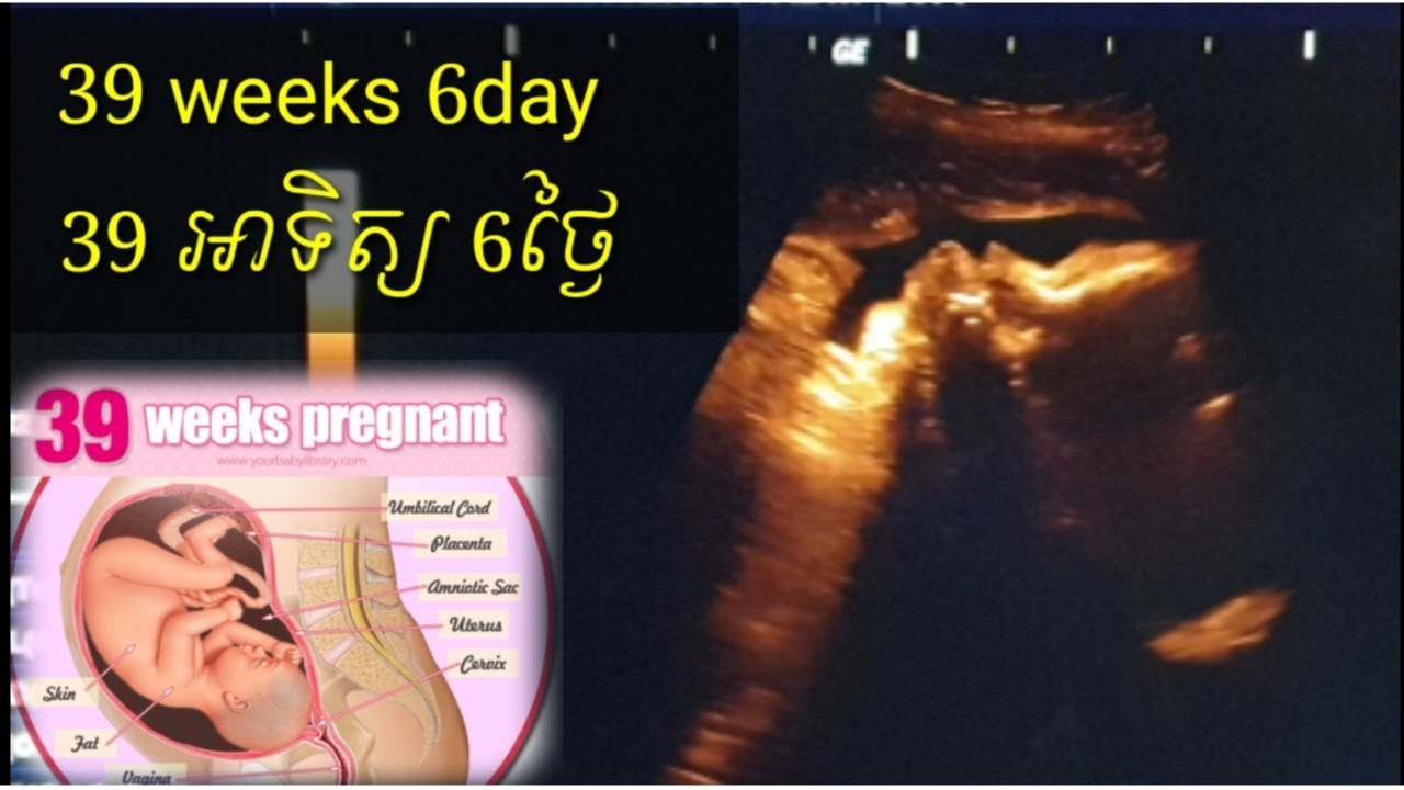 អេកូផ្ទៃពោះ 39 អាទិត្យ 6ថ្ងៃ pregnancy ultrasound 39 weeks 6day by Dr ...