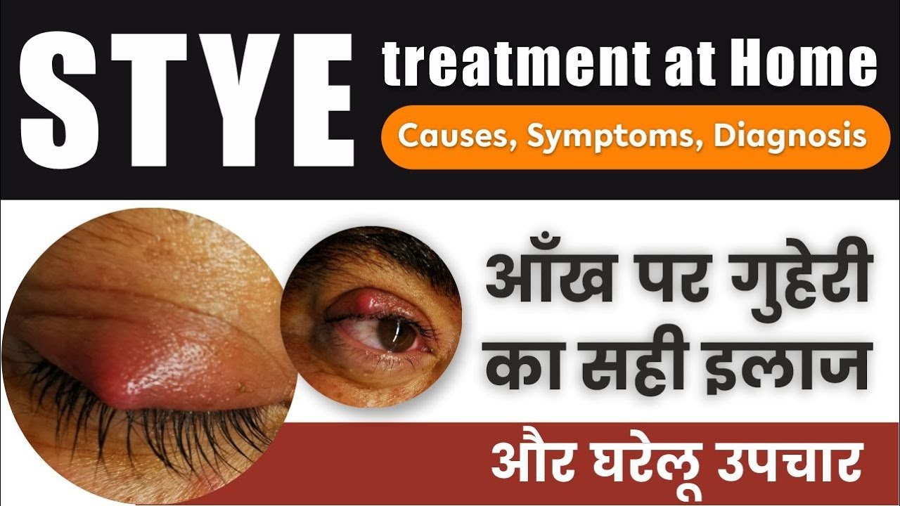 Stye Treatment & Homely tips | How to prevent Eye infection | आँख पर ...