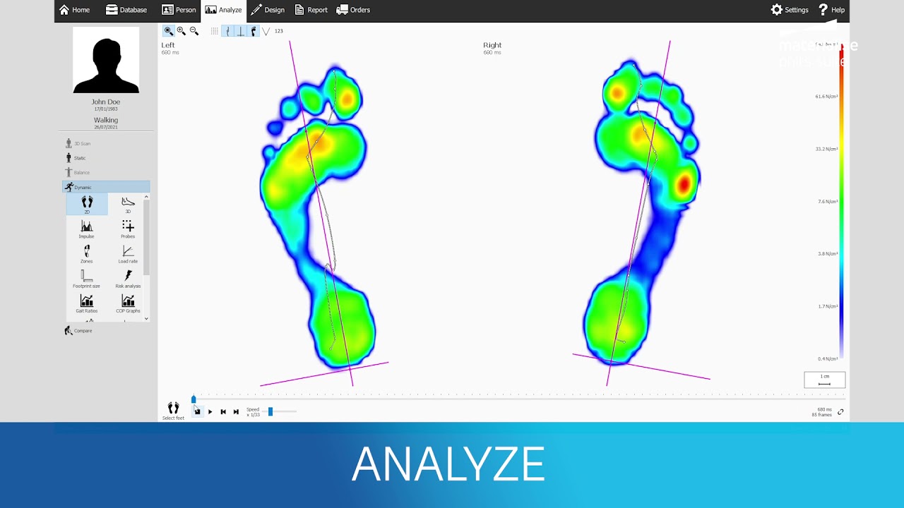 Create Custom Orthotics with a Digital Workflow | Materialise Phits ...
