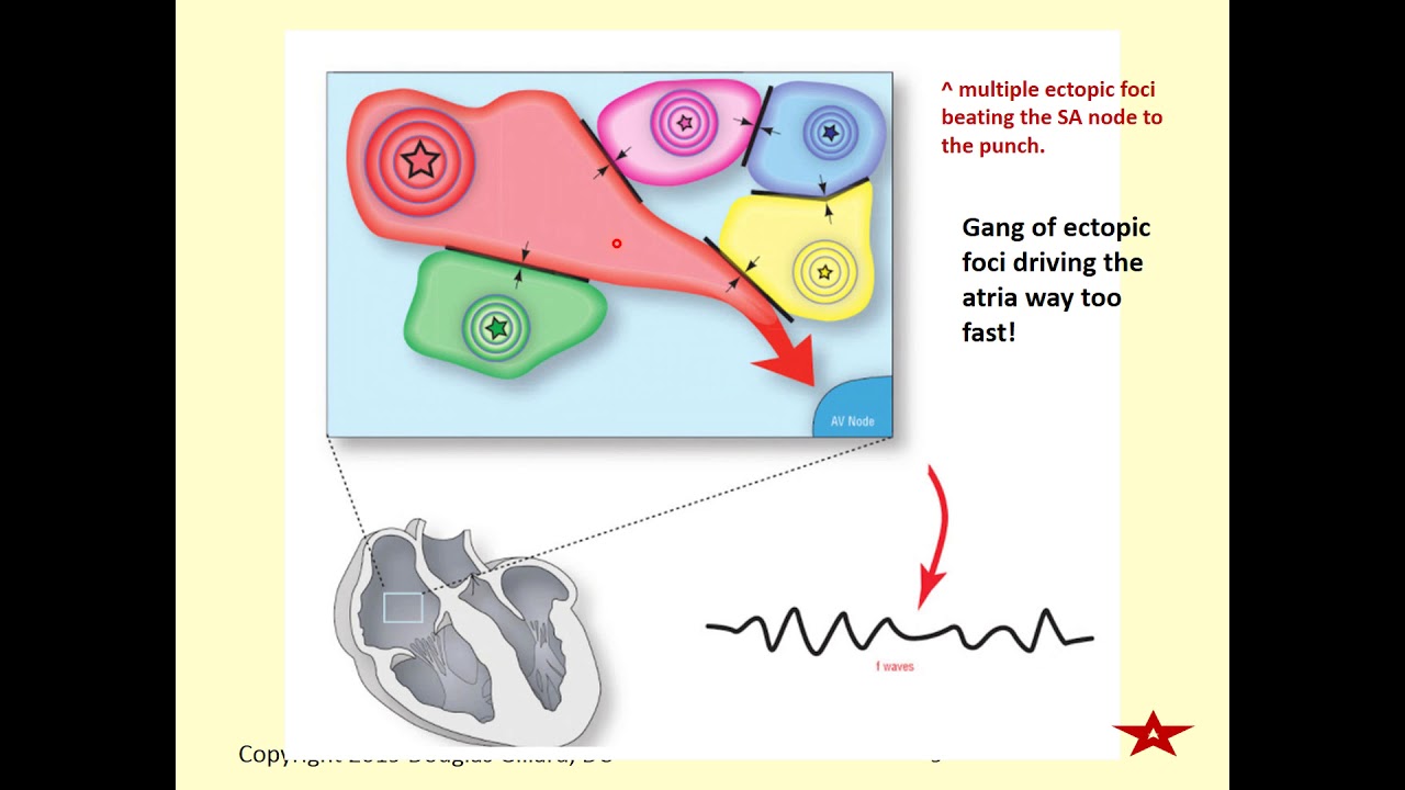 Atrial Fibrillation & Accessory Conduction Pathways: An Advance Lecture ...