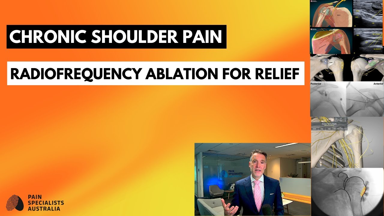 Is This the Future of Shoulder Arthritis Pain Relief? - YouTube