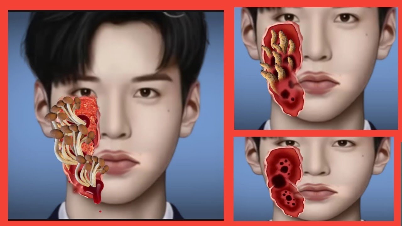 ASMR/Remove Maggots & Face Tone removal fungus from infected face/Severely injured animation ...