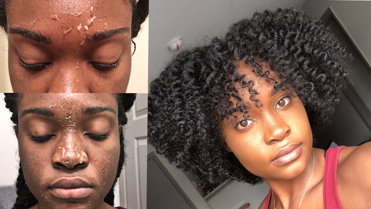 I GOT ANOTHER CHEMICAL PEEL! | JESSNER CHEMICAL PEEL VLOG 2 - YouTube