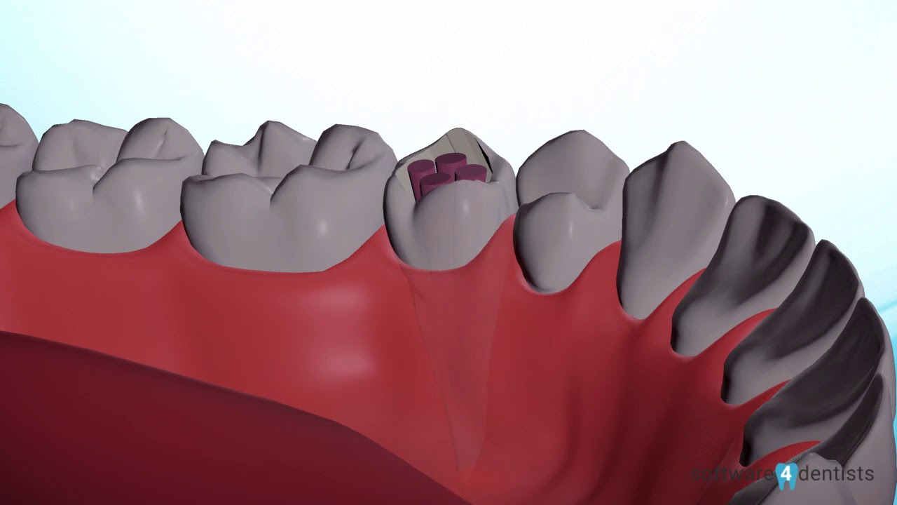 Dental root treatment - YouTube