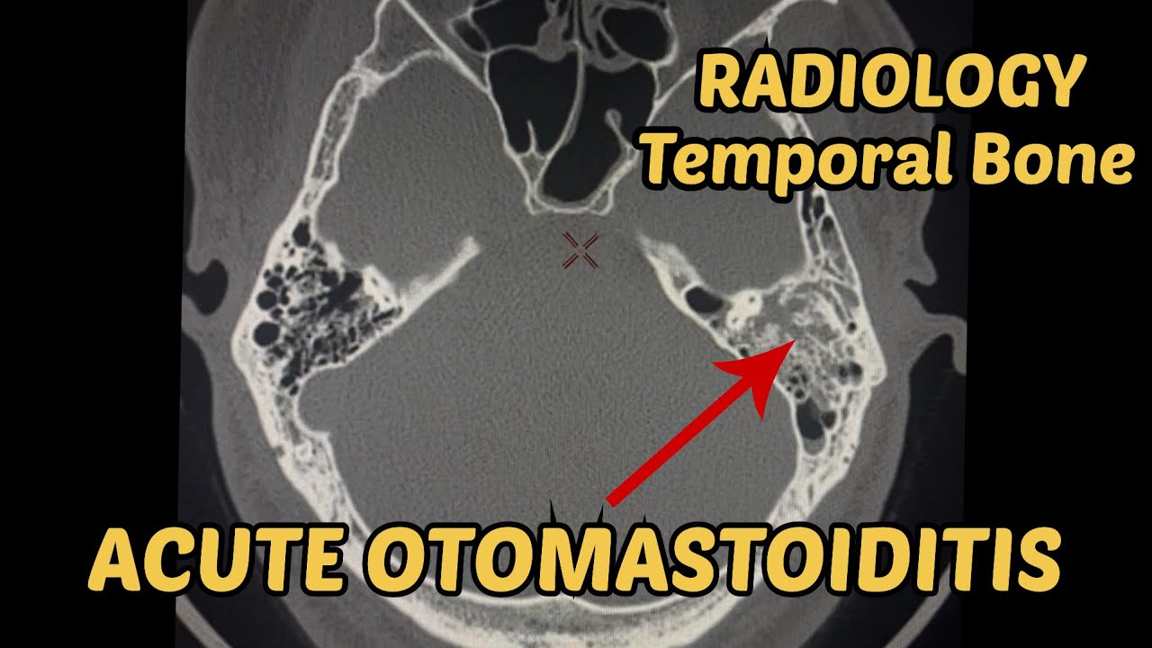 Acute Otomastoiditis | Ct scan |Radiology | - YouTube