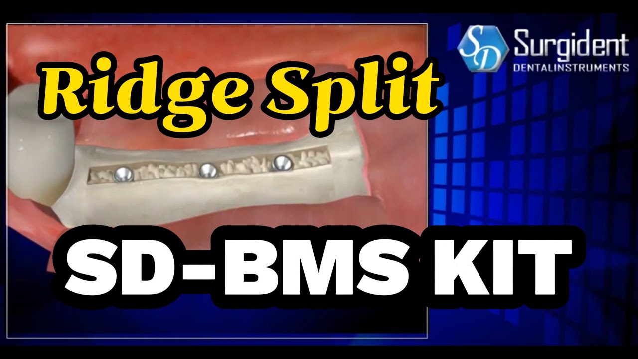 Ridge split system - YouTube