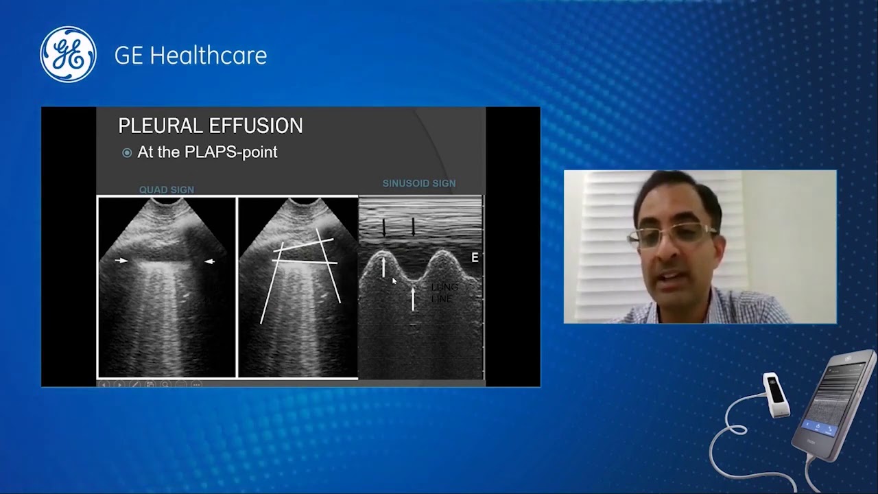 Vscan Extend Product Launch:Role of Lung Ultrasound during Pandemic by ...