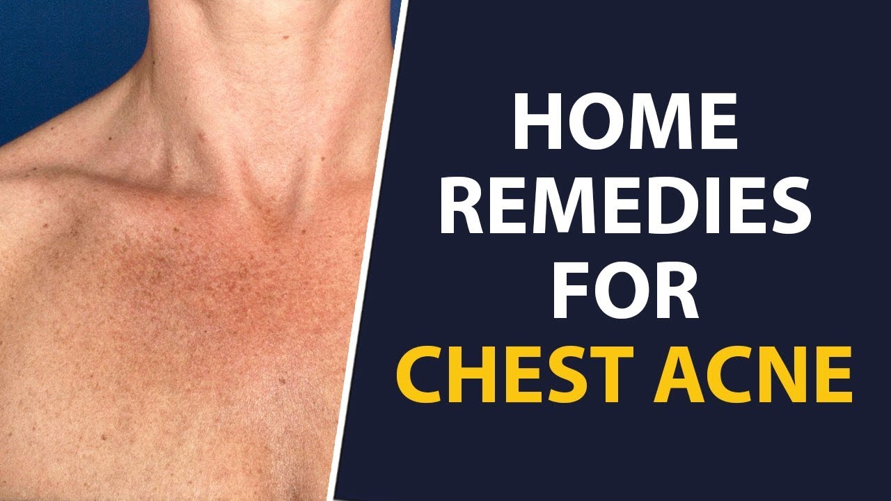 Home Remedies To Get Rid Of Chest Acne Permanently | Remedies For Chest ...