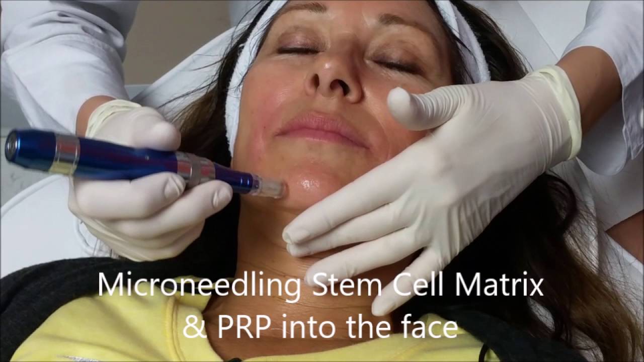 Stem Cell Facial, PRP Facial, Microneedling, Hyperbaric Chamber - YouTube