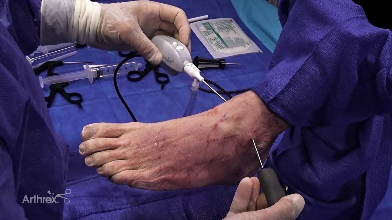 NanoScope™ Camera for Foot and Ankle Arthroscopy - YouTube