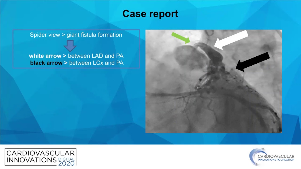 Calik Percutaneous Closure of a Complex Fistula which Originates ...