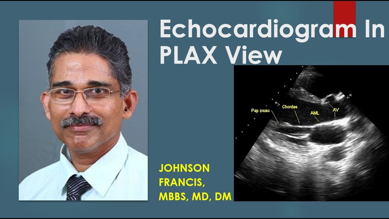 Echocardiogram in PLAX view - YouTube