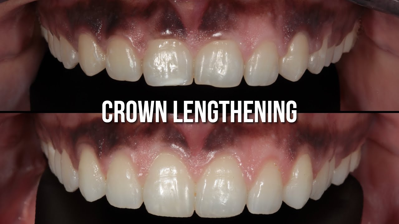 Crown Lengthening - Gummy Smile - YouTube