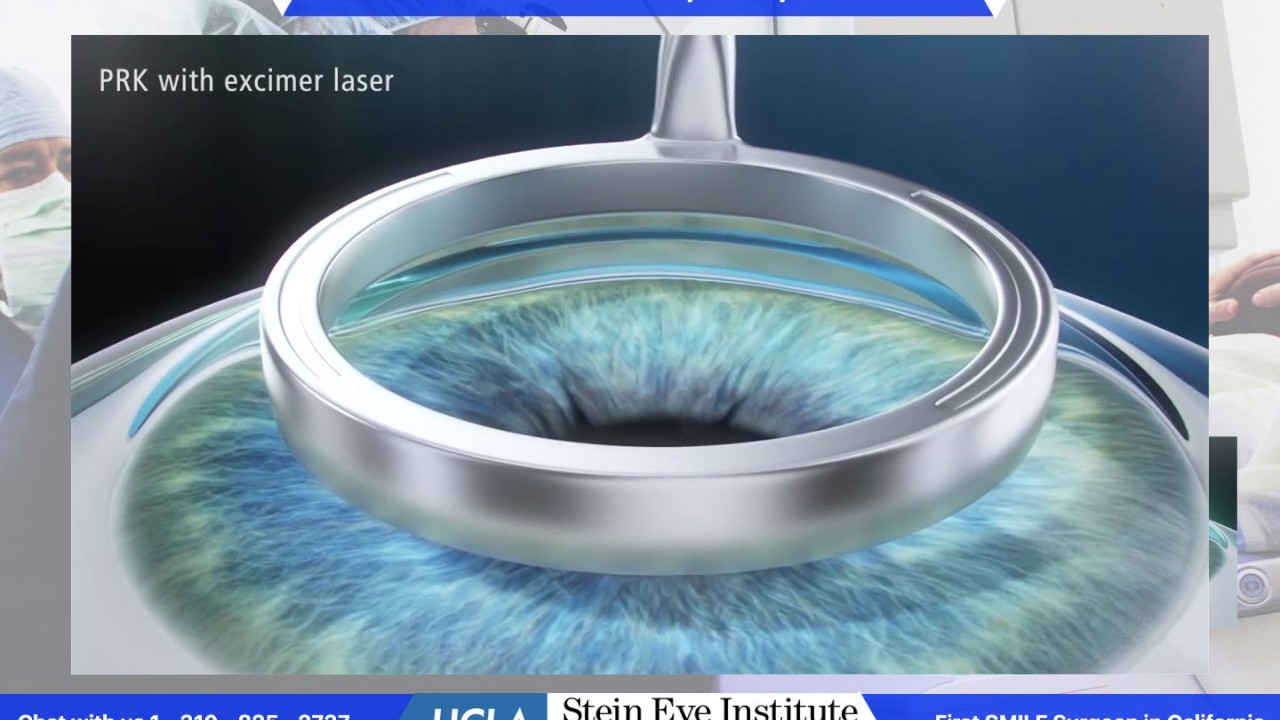 UCLA PRK Quick and Simple - YouTube