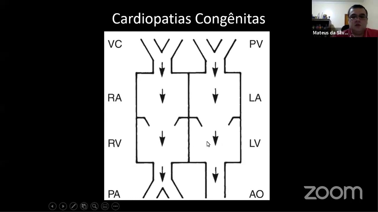 Cardiopatias congênitas de shunt Esquerda-Direita: apresentação clínica ...