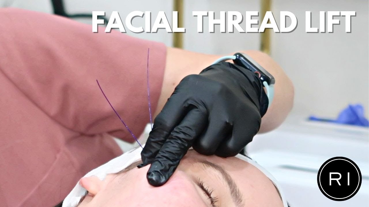 Non Surgical Face Lift with PDO Threads | Before and After ...