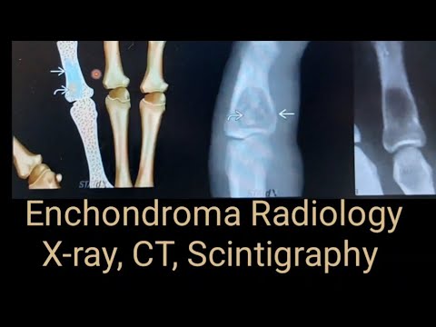 Enchondroma Radiology x ray. CT and Scintigraphy. Study points - YouTube