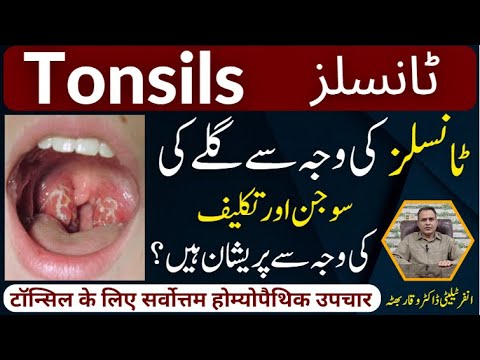 Tonsils / Galy ki soojan گلے کی سوجن اور تکلیف टॉन्सिल Homeopathic ...