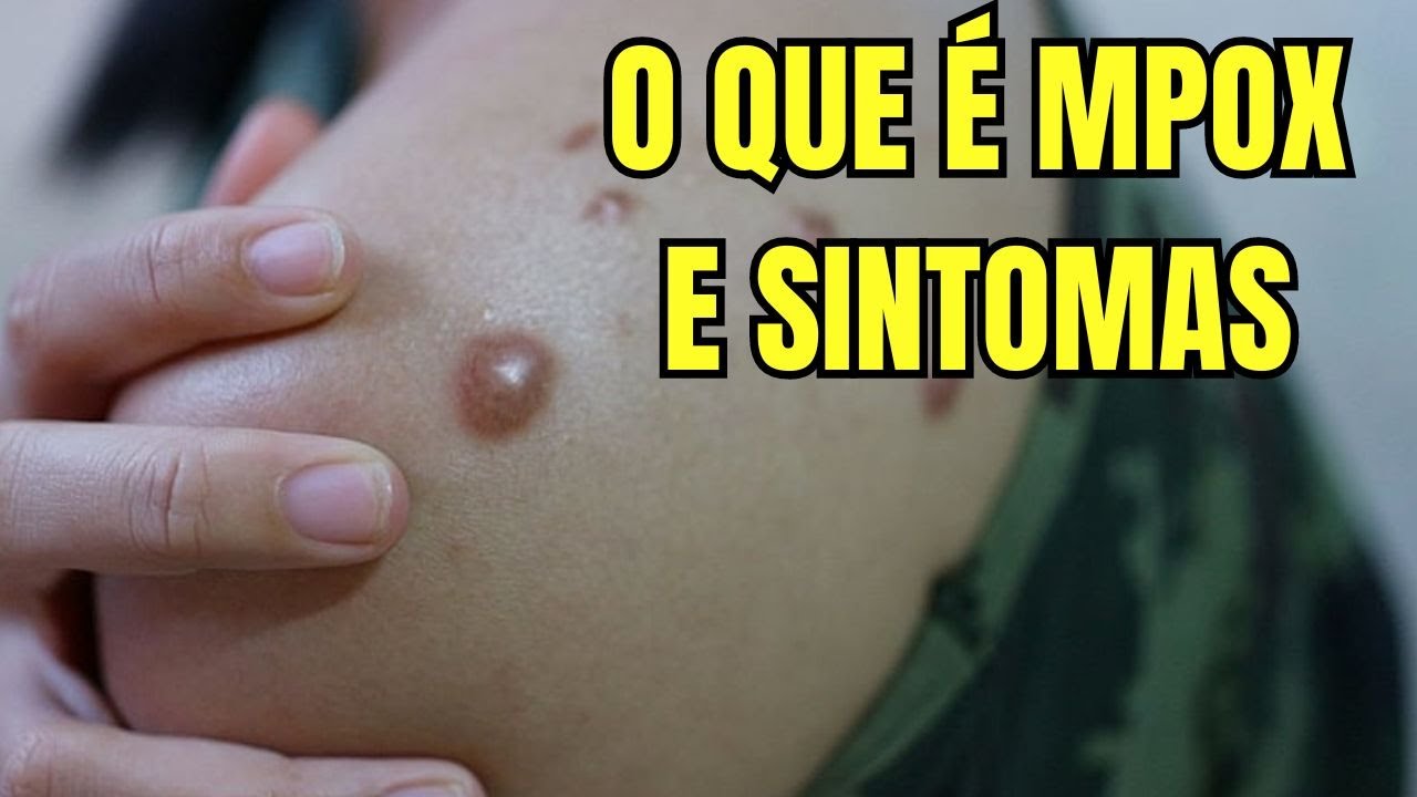 O QUE É MPOX - SINTOMAS DA DOENÇA - YouTube