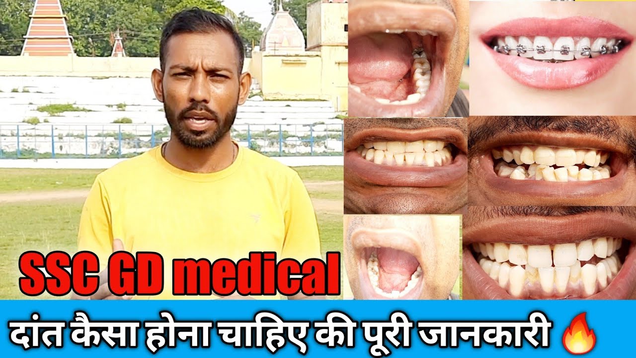 Defence Teeth Medical || SSC GD Medical में दांत Check करने की पूरी ...