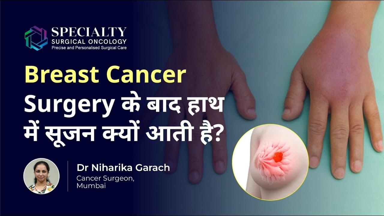 Breast Cancer Surgery के बाद हाथ में सूजन आना | Hand Swelling After ...