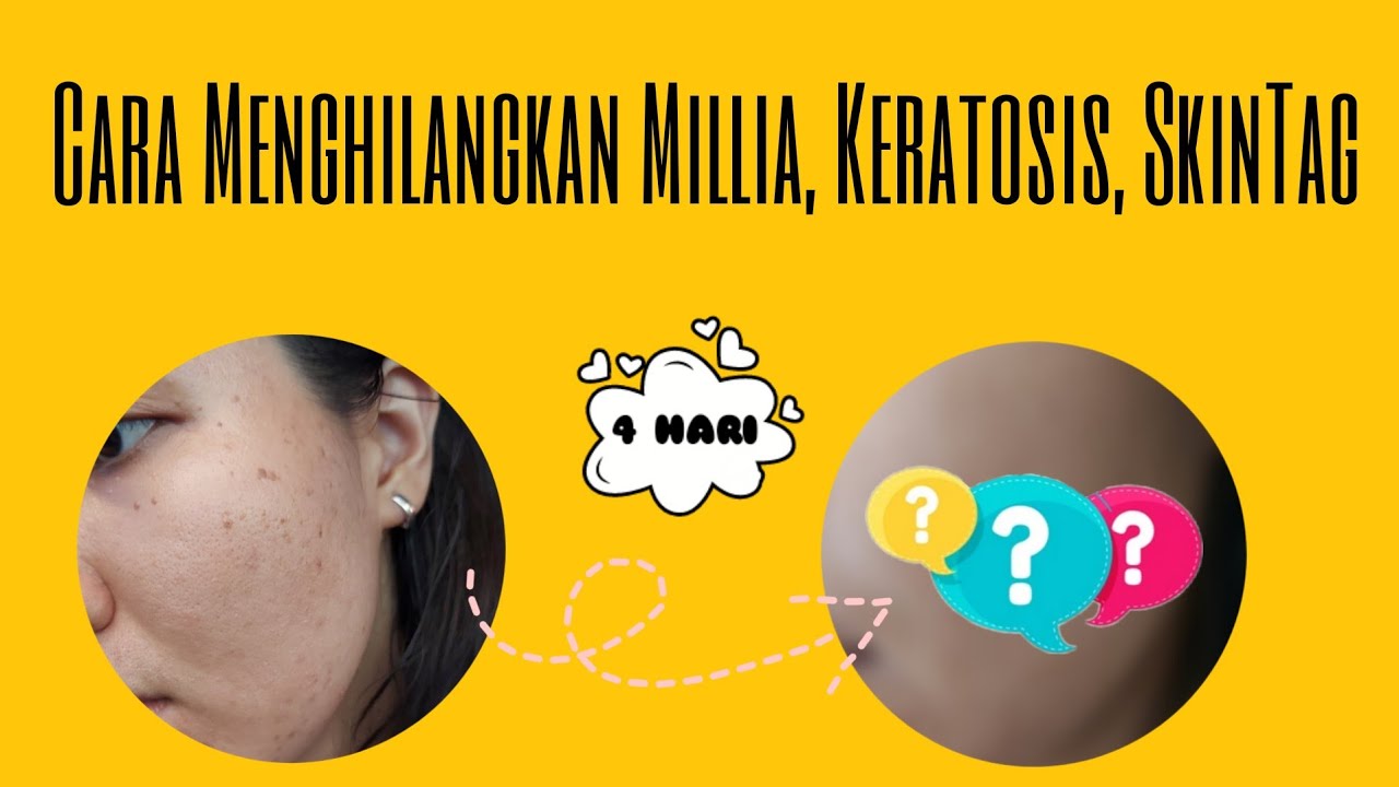 Kutil di Muka (MILIA, SKIN TAG dan KERATOSIS SEBORIK) HILANG dalam 4 ...