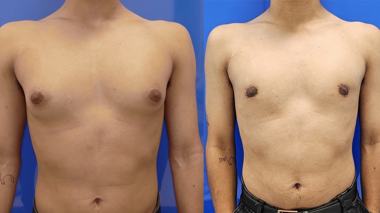 Use of Round-Block & Indocianine Green Angiography in patient with ...