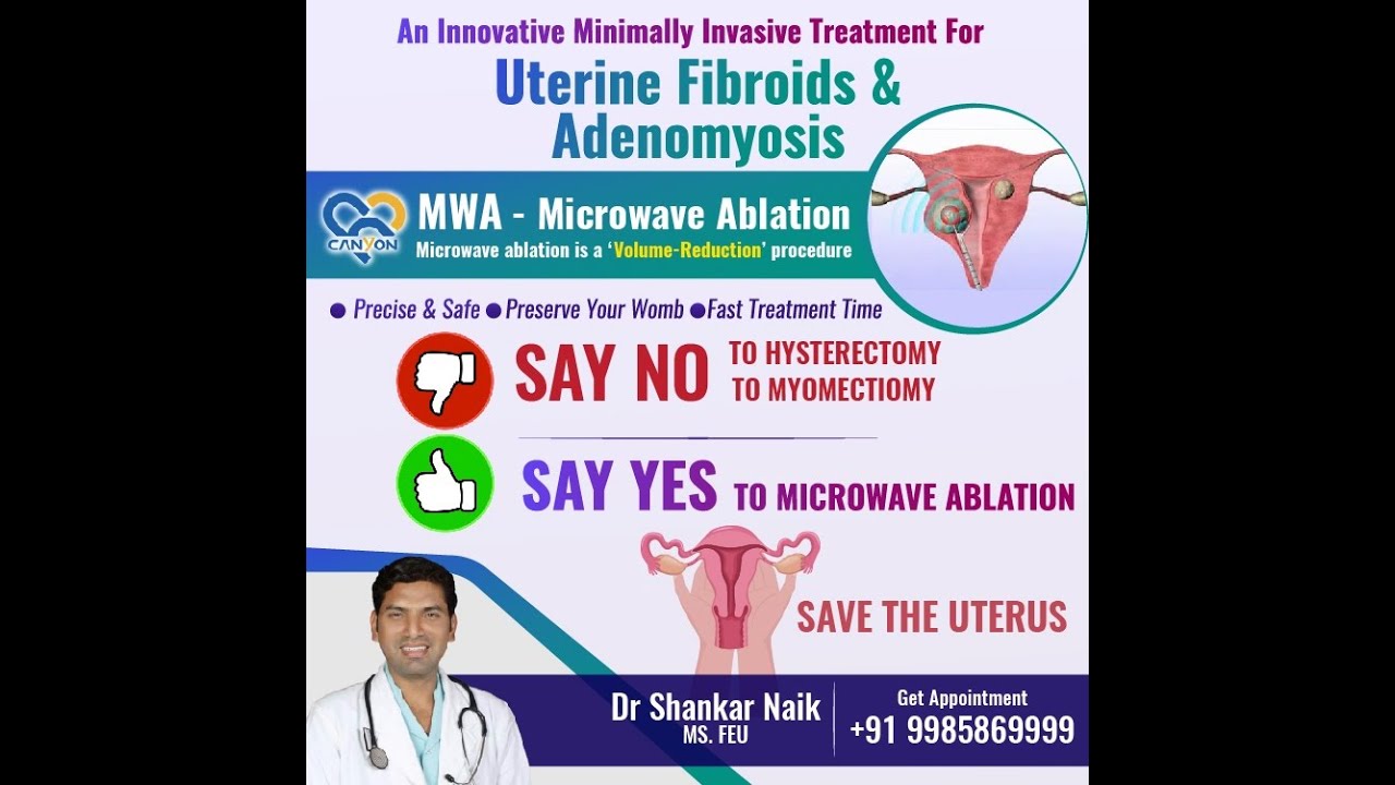 MWA Uterine fibroid ablation - YouTube