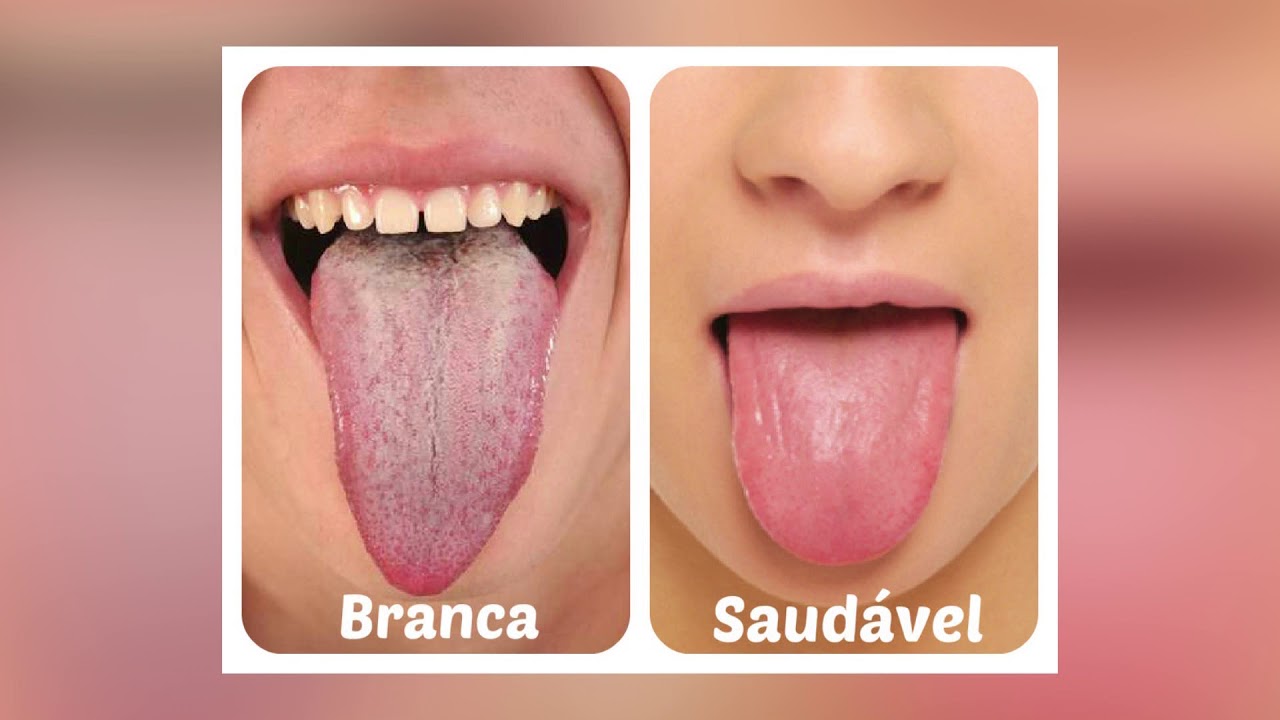 DICA SAÚDE BUCAL 25 02 18 ELISABETE GASPAR SABURRA LINGUAL - YouTube