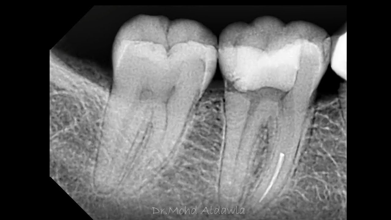 Separated file removal - YouTube