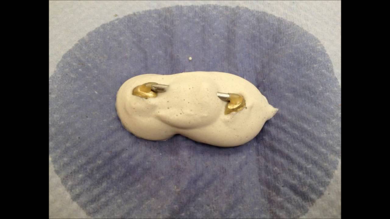 Precision attachment retained overdentures Part - 2 - YouTube