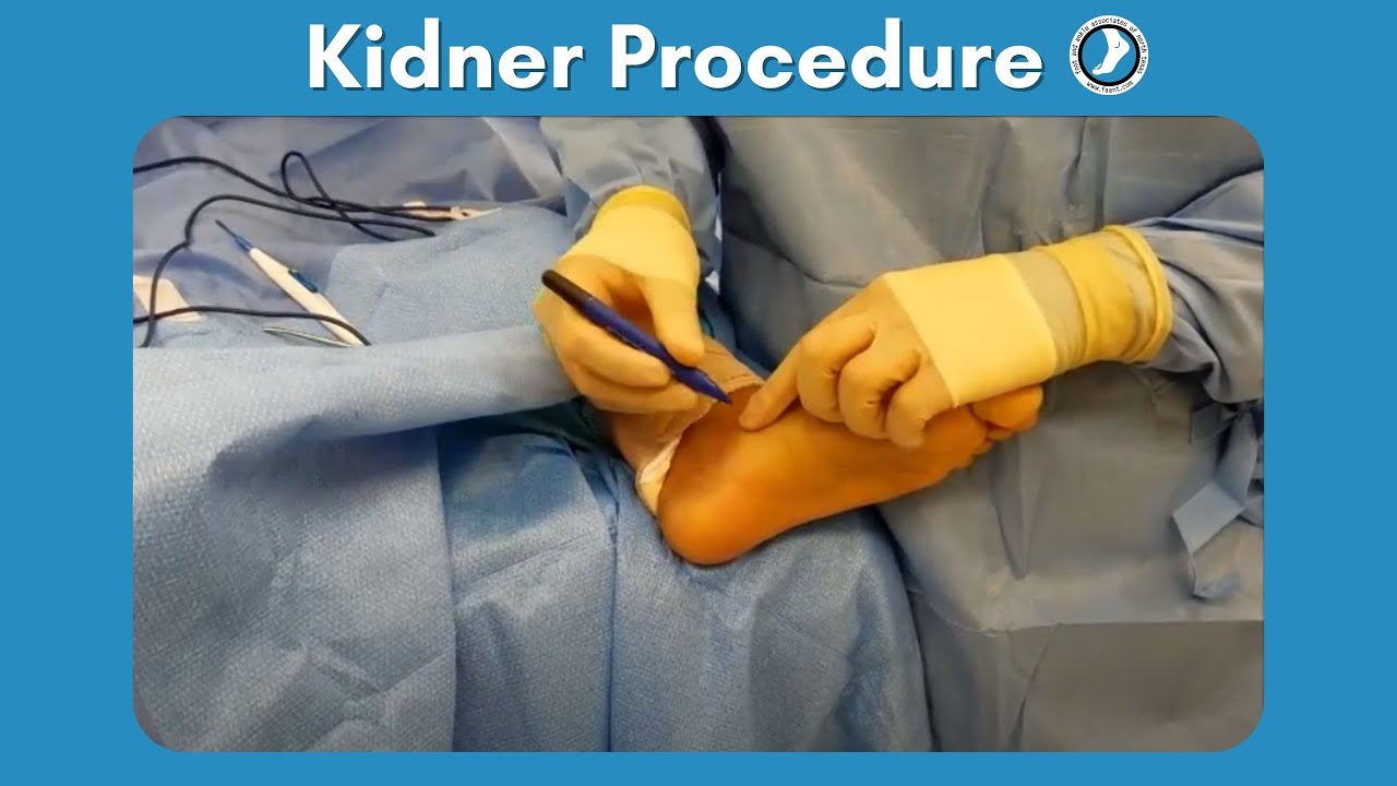 Kidner Procedure performed by Dr. Paul Steinke - YouTube