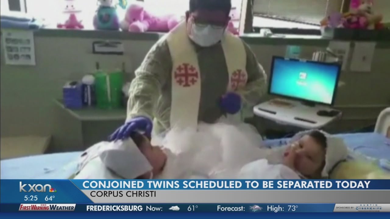 Twins joined at the pelvis to be separated in 12 hour surgery - YouTube