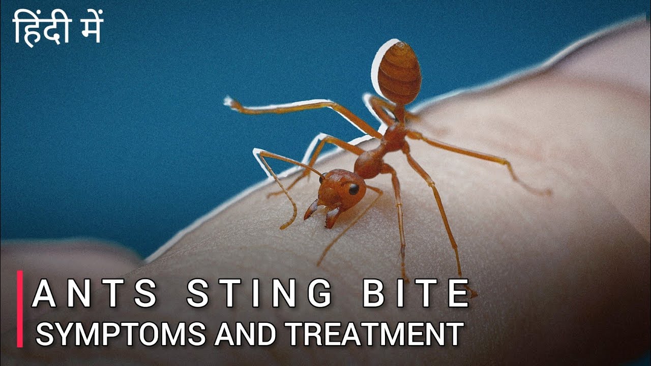 Ants Sting Bite on Skin | Treatment | Symptoms | Prevention | Acids ...
