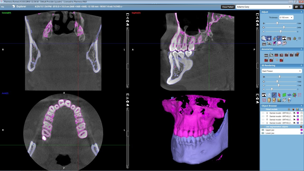 Planmeca Romexis® 4.5 highlights - YouTube