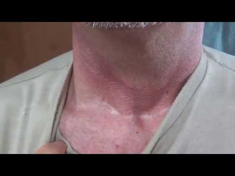 Rapid Subclavian Artery, or high JVP? - YouTube