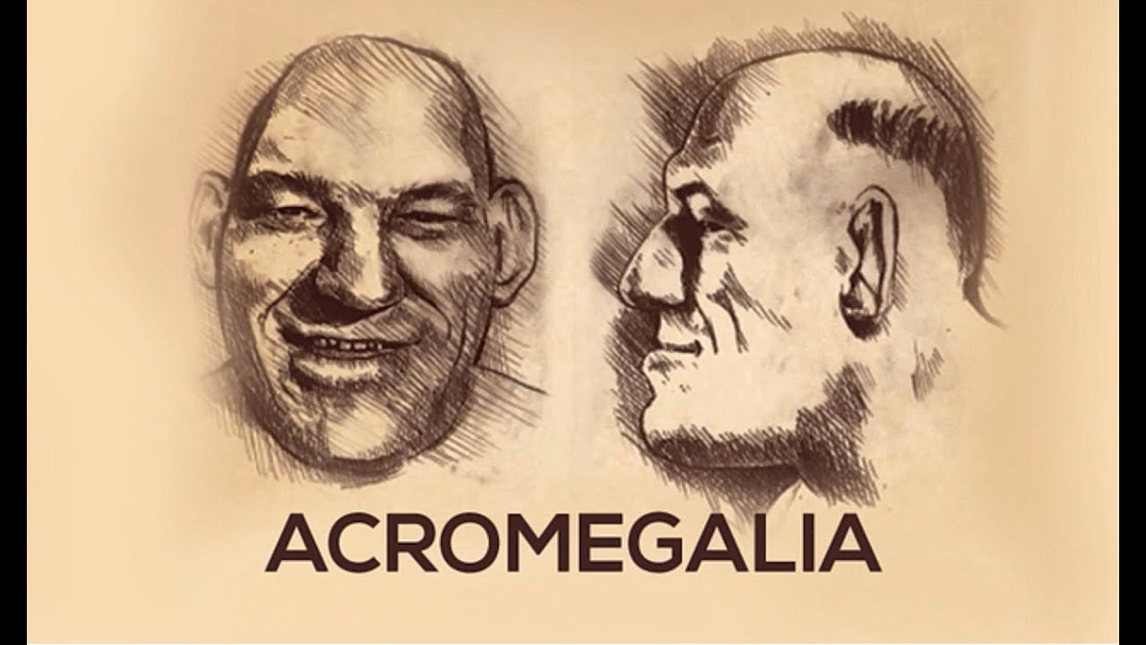 Personas Con Acromegalia Hospital Universitario Virgen Del Rocio