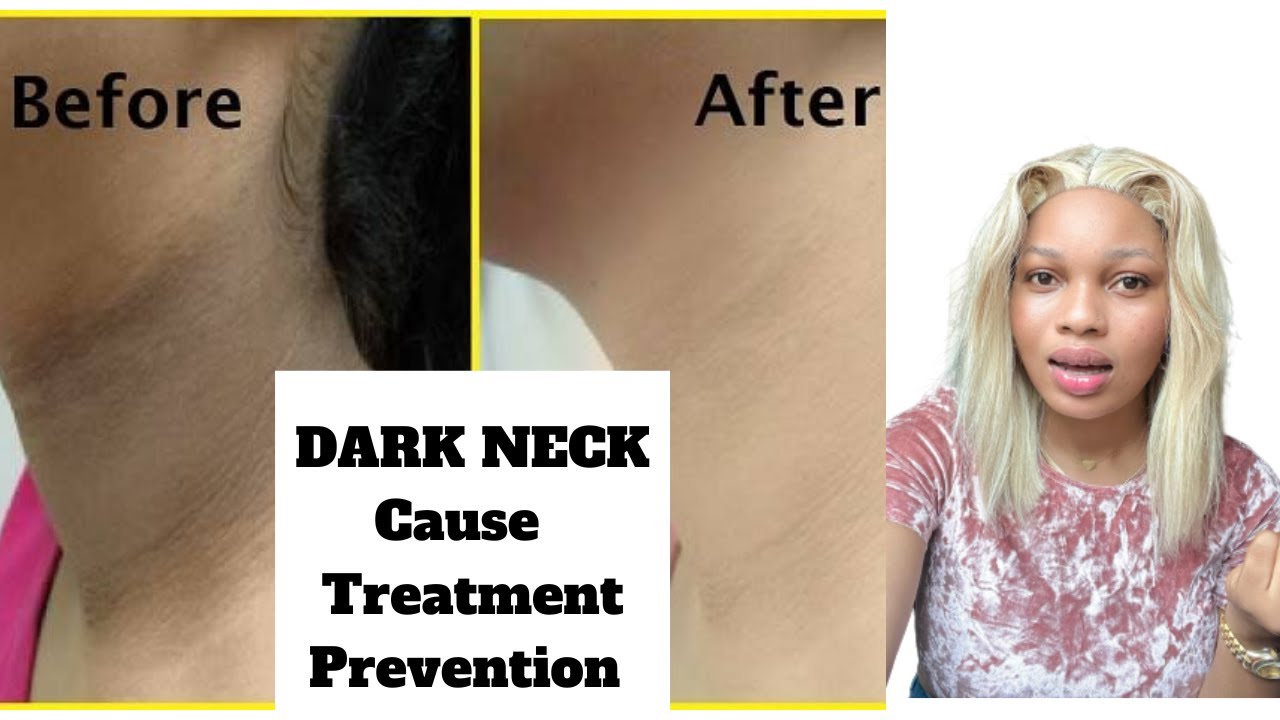 How to lighten your hyperpigmentation around the neck/discoloration on ...