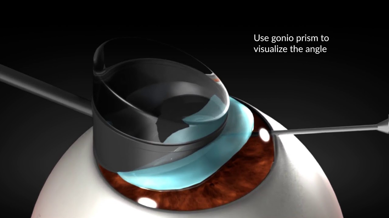 Kahook Dual Blade: Cuchillete oftálmico para goniotomía escisional ...