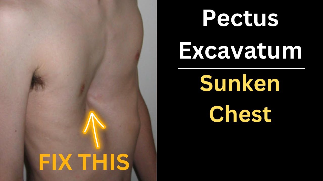 PERMANENT Fix for your Sunken Chest! - YouTube