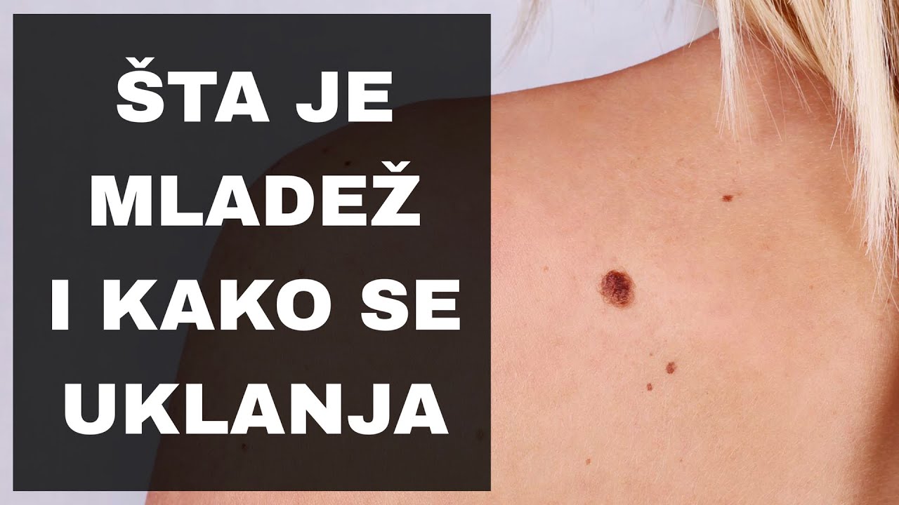 Šta je mladež, da li su opasni i kako se uklanjaju... - YouTube