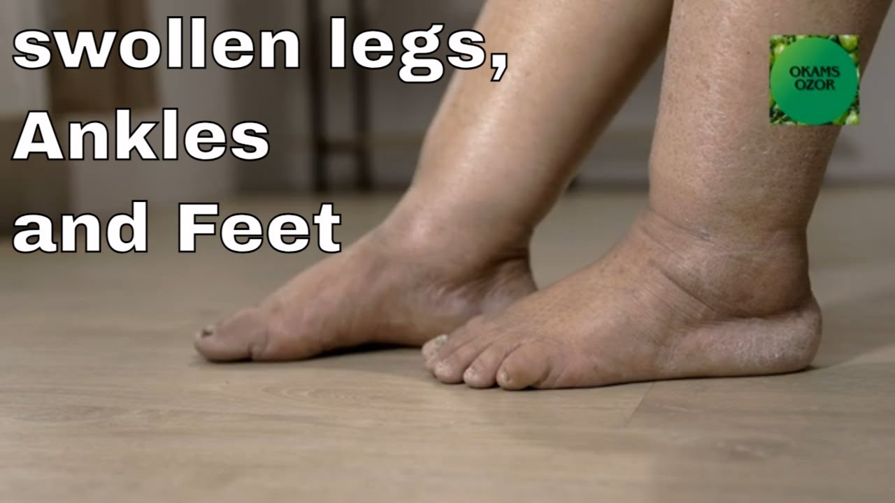 Want to Reduce Swelling leg Fast? Watch This Now (Swollen legs ,Ankles ...