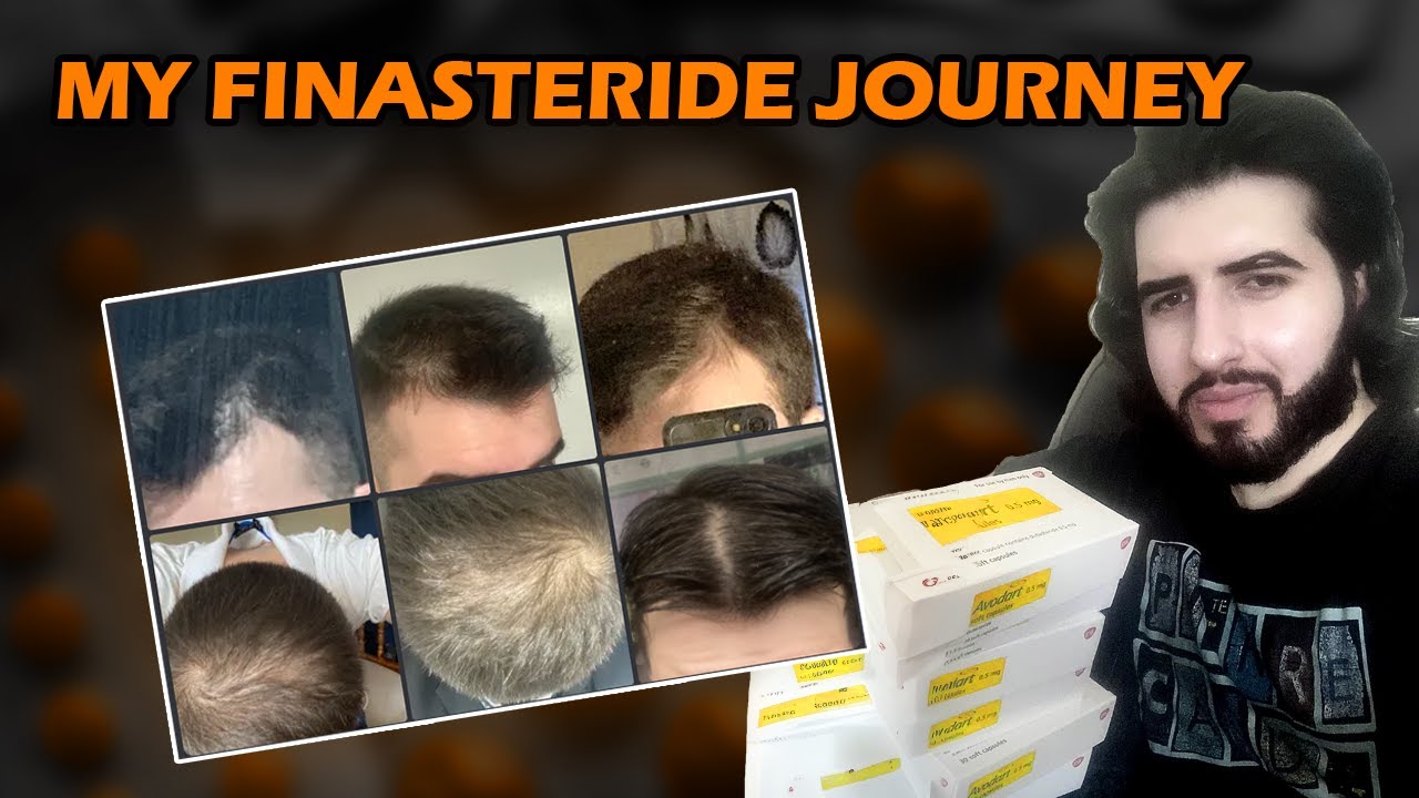 I REJECTED BALDNESS - My Hair Loss Story and Finasteride - YouTube