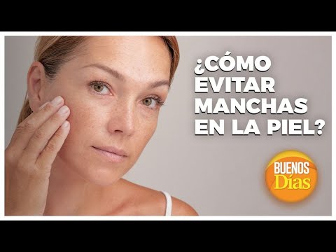¿Cómo tratar y evitar manchas en la piel? – Nathaly Gerbino | Buenos Días