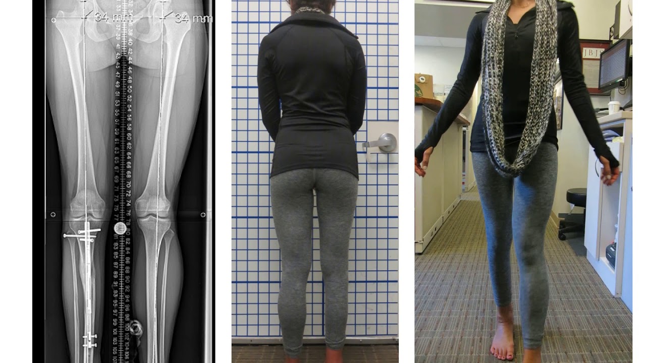 When to Amputate and When to Reconstruct - YouTube